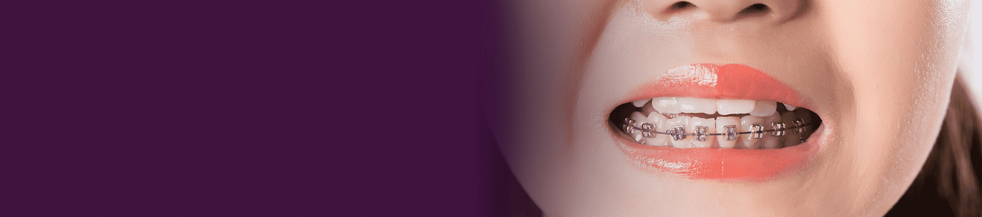 Traditional Braces Melbourne | Smile Solutions